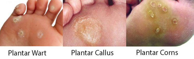Best Plantar Callus Removal Treatment You Ask The Question We Find best-plantar-callus-removal-treatment-you-ask-the-question-we-find